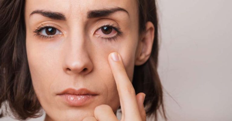Dermatite Palpebrale: Cause, Sintomi e Rimedi
